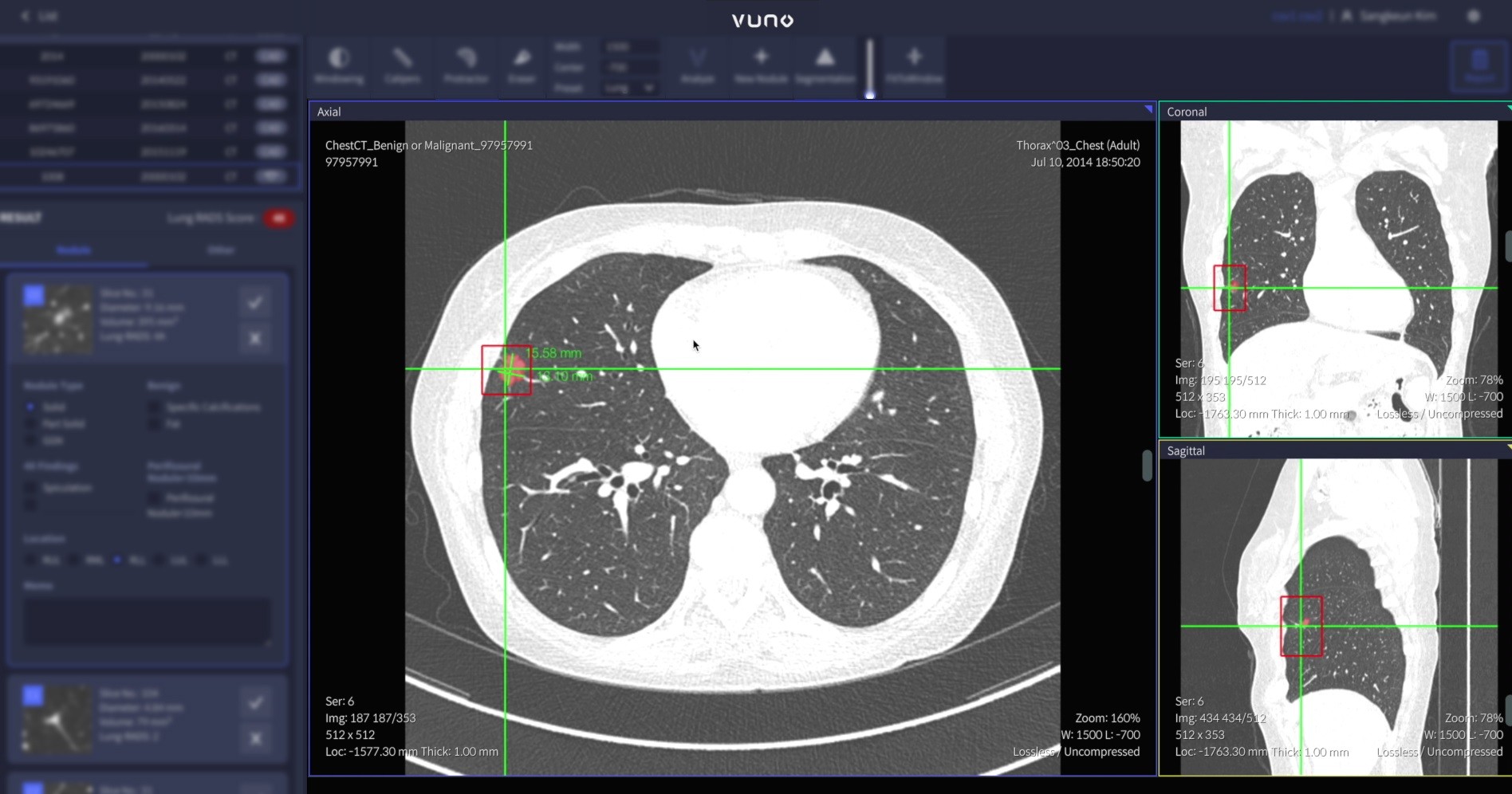 VUNO Med®-LungCT AI™ receives MFDS Regulatory Approval - VUNO, View the ...