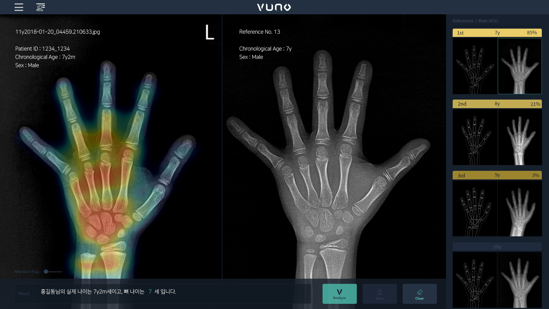 국내 1호 인공지능 의료기기, 국내기업 최초로 해외 인증받아 / VUNO wins CE for AI-based medical ...