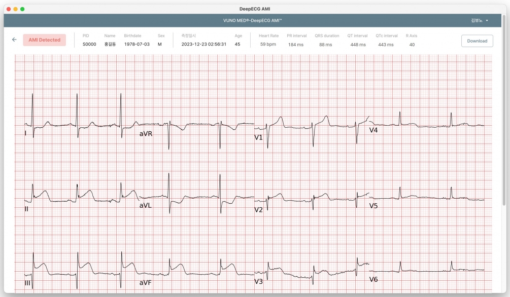 뷰노, 급성심근경색 탐지 AI 의료기기 식약처 허가 획득 - 뷰노, View the Invisible, Know the Unknown