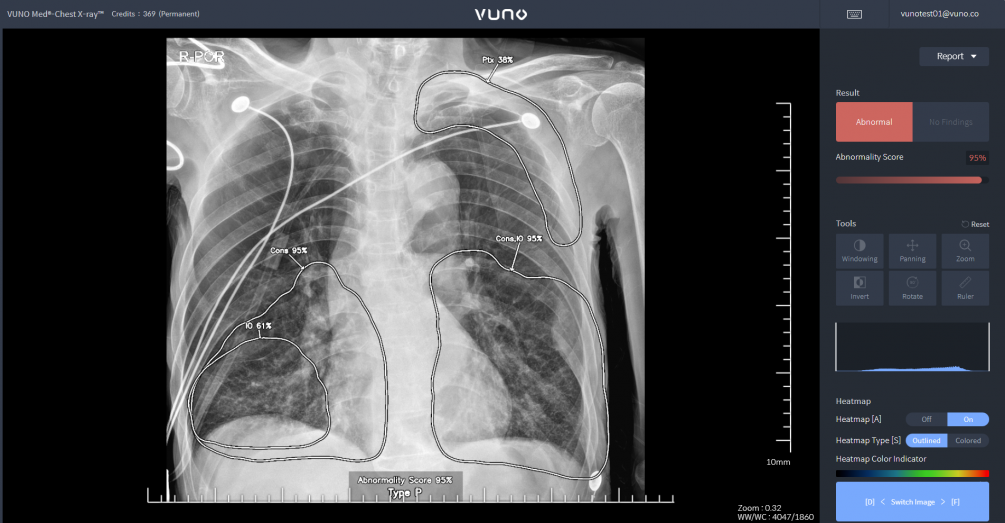 뷰노, 흉부 영상 진단 보조 AI ‘Chest X-ray’ 비급여 청구 시작 - 뷰노, View the Invisible ...
